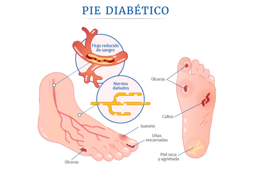 pie diabetico – cirugiavascularyendovascular.com